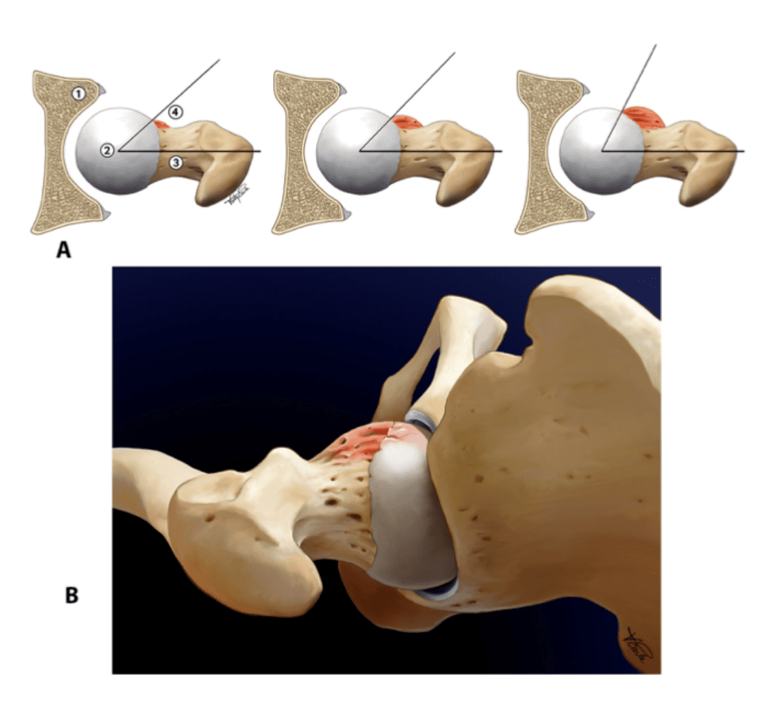 Hip and Groin pain - Advanced Clinical Education Educating, mentoring ...