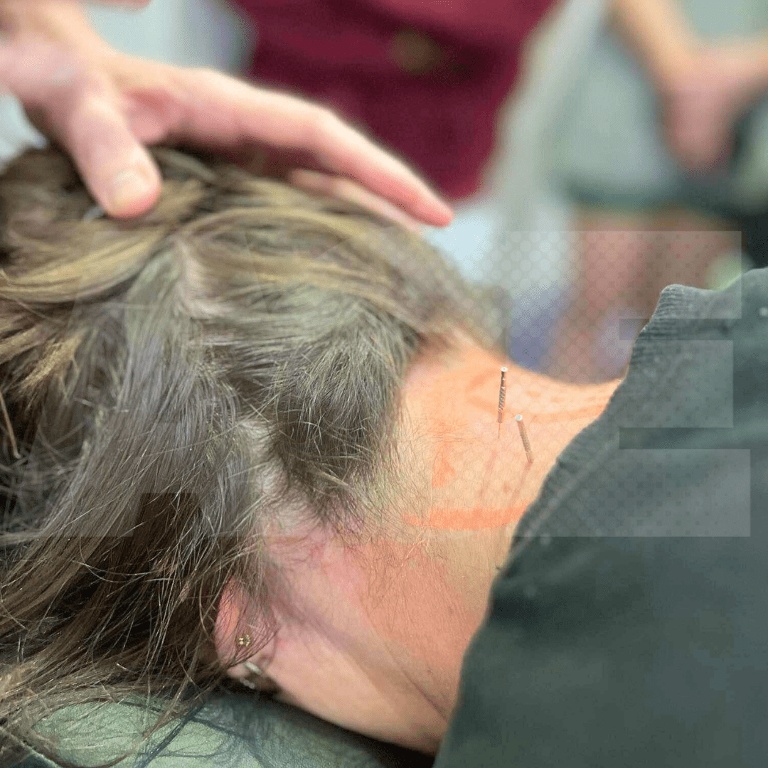Dry Needling Course | Advanced Clinical Education