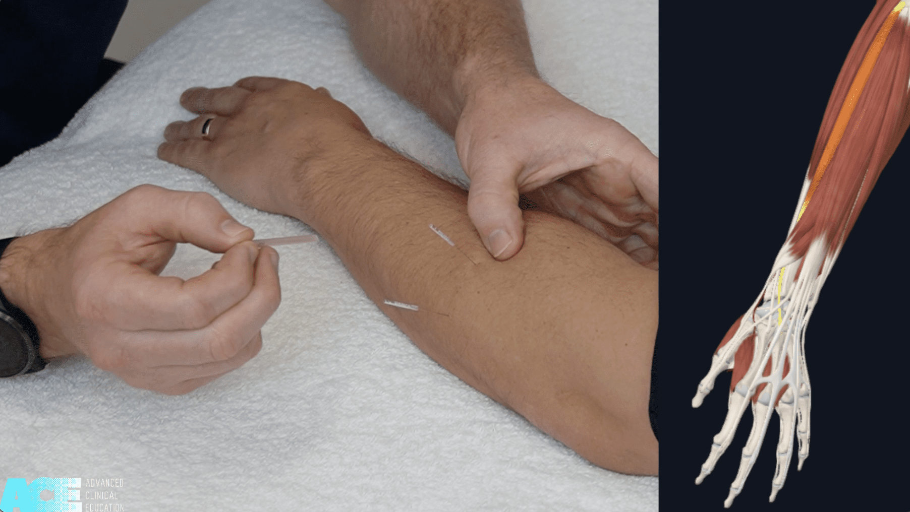 Dry Needling Course | Advanced Clinical Education
